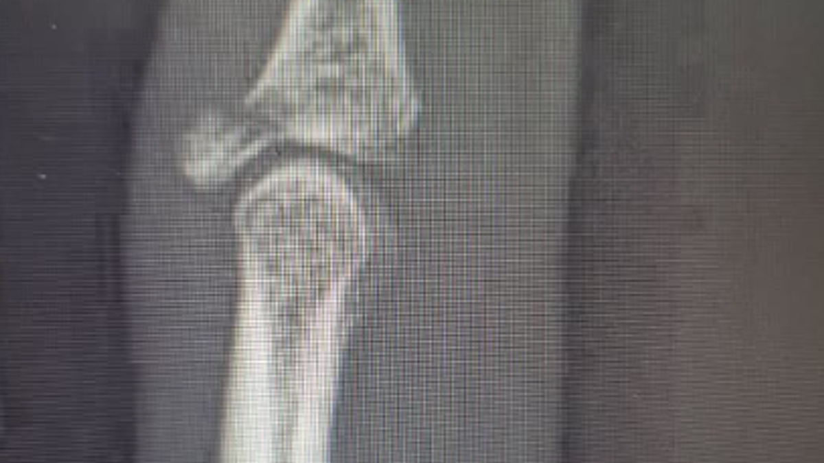 Paltrinieri mostra radiografia dito rotto, 'ma ne ho altri nove'