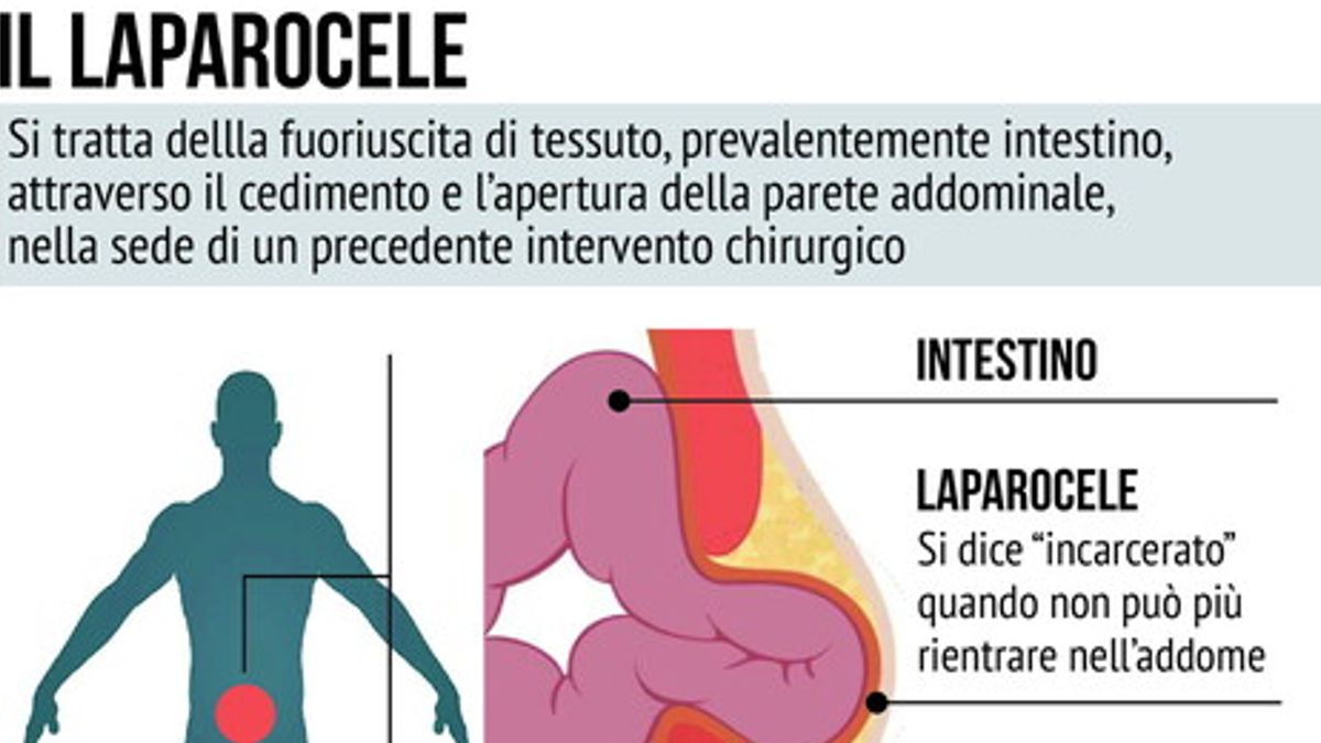 Che cos'è il laparocele di cui soffre il Papa