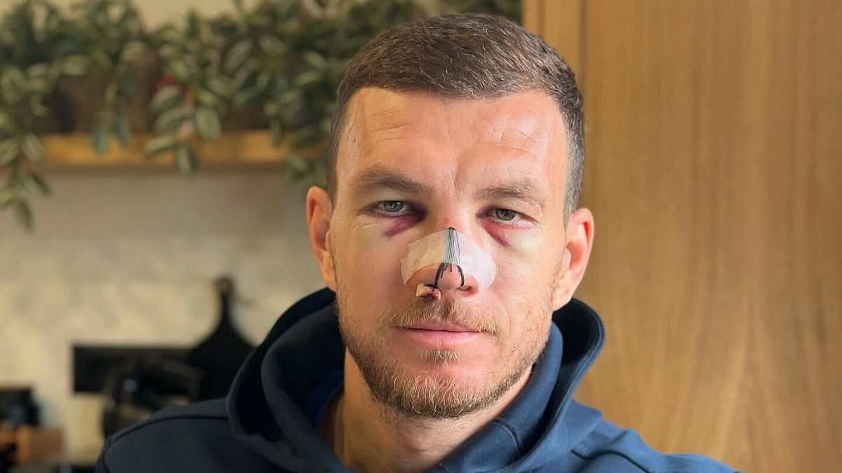 Dzeko occhio nero e naso rotto con la Bosnia, 'tutto o niente'